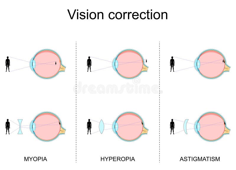 Vision Defects. Myopia, Hyperopia, Astigmatism Stock Vector ...