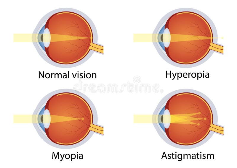 Hyperopia and Normal Vision Stock Vector - Illustration of anatomical ...