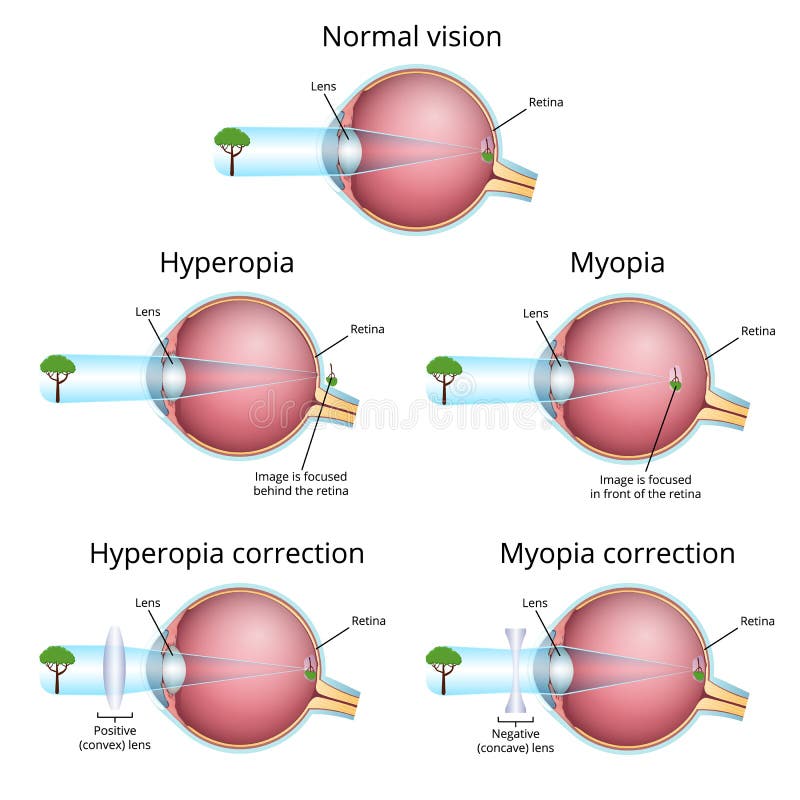 Vision Defects - Myopia, Hyperopia and Astigmatism Stock Vector ... Vision Defects - Myopia, Hyperopia and Astigmatism Stock Vector ...