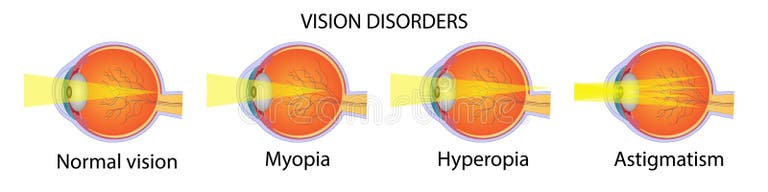 Visual Impairment Diagram with Names and Eyeball Structure Vector ...