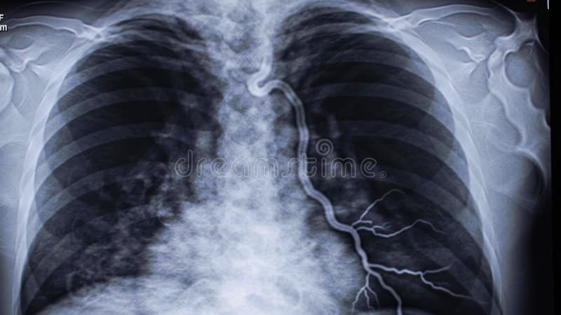 Visible Heart and Lung Anatomy in Chest X-ray Showing Detailed Vascular ...