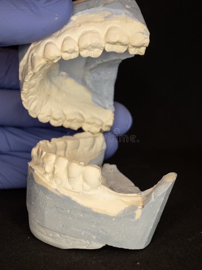 Visualisation of Jaws Defects on Colored Plastic Model Stock Image ...