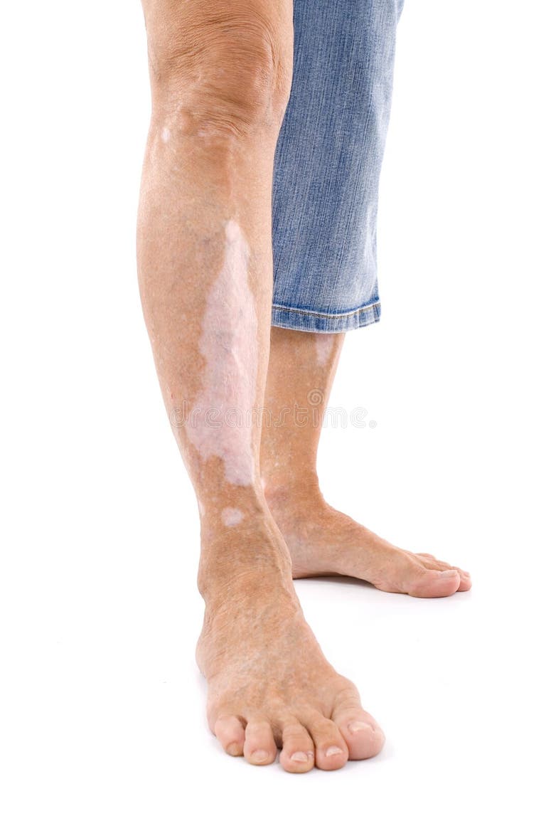 3,834 Vitiligo Skin Stock Photos - Free & Royalty-Free Stock Photos ...