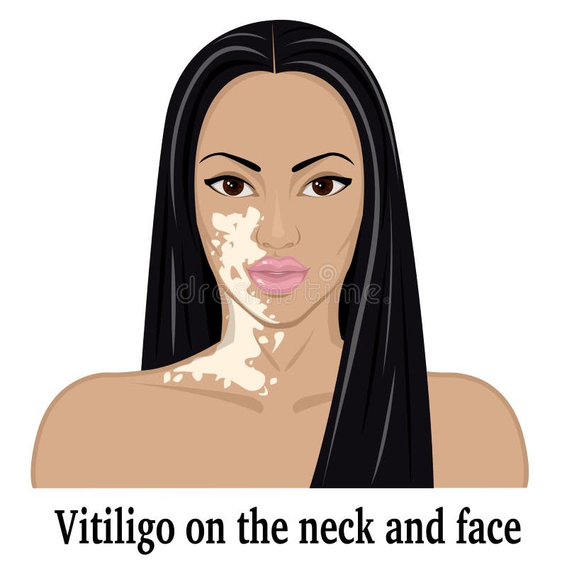 Vitiligo on the Neck and Face Stock Vector - Illustration of illness ...