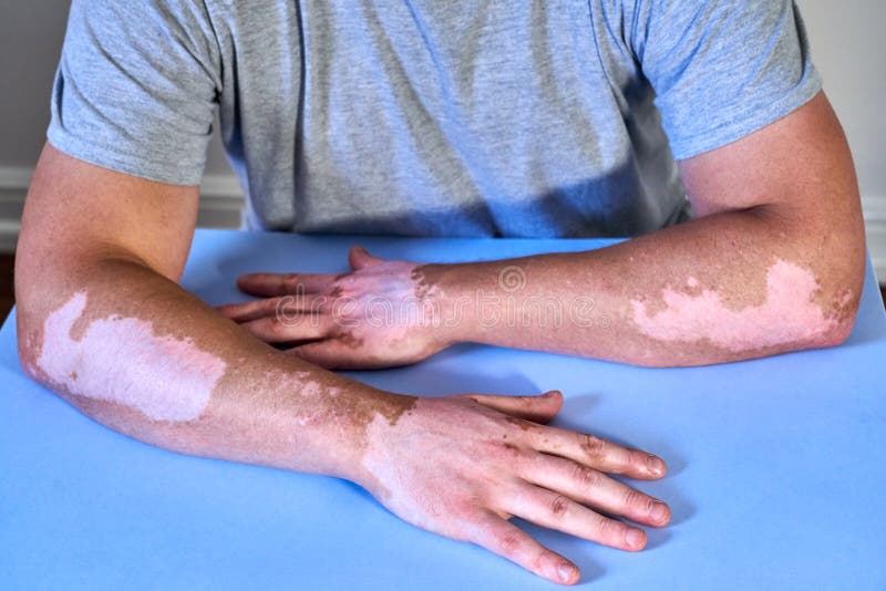 Vitiligo Skin Disease on Male Hands Stock Image - Image of condition ...