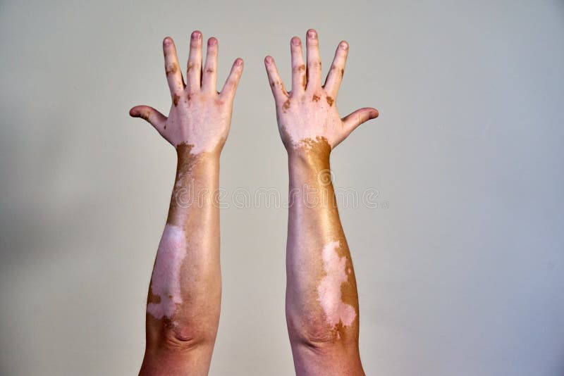 Vitiligo Skin Disease on Male Hands Stock Image - Image of skin ...