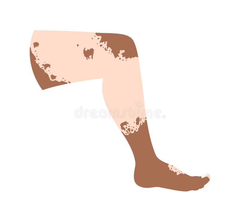 Vitiligo on Skin Layer Anatomy Stock Vector - Illustration of organ ...