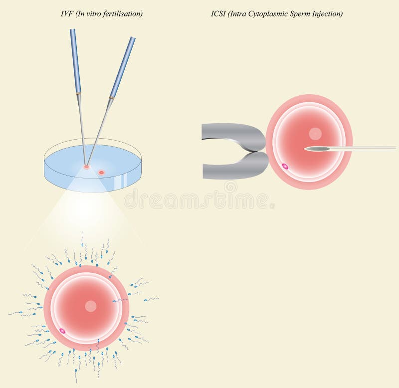 In Vitro Fertilization Diagram