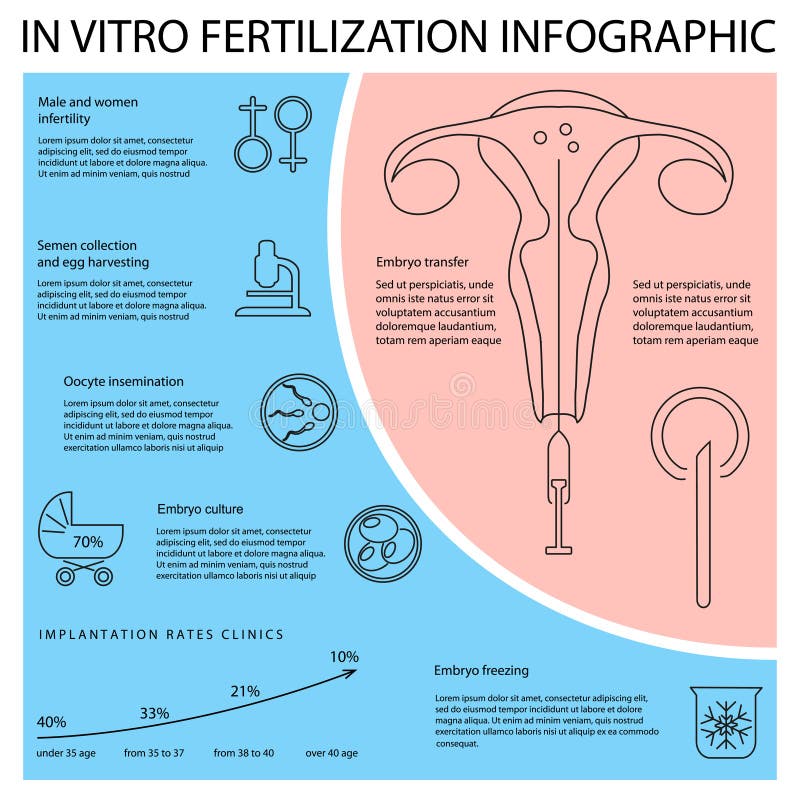In Vitro Fertilization Infographic. Stock Vector - Illustration of ...