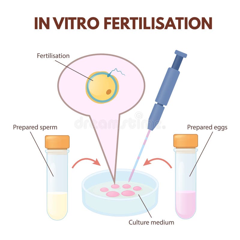 Stages Of Baby Birth In Vaginal Delivery Stock Vector - Illustration of ...