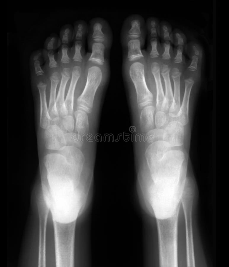 Voet stock afbeelding. Image of lichaam, artritis, gloed - 2272557