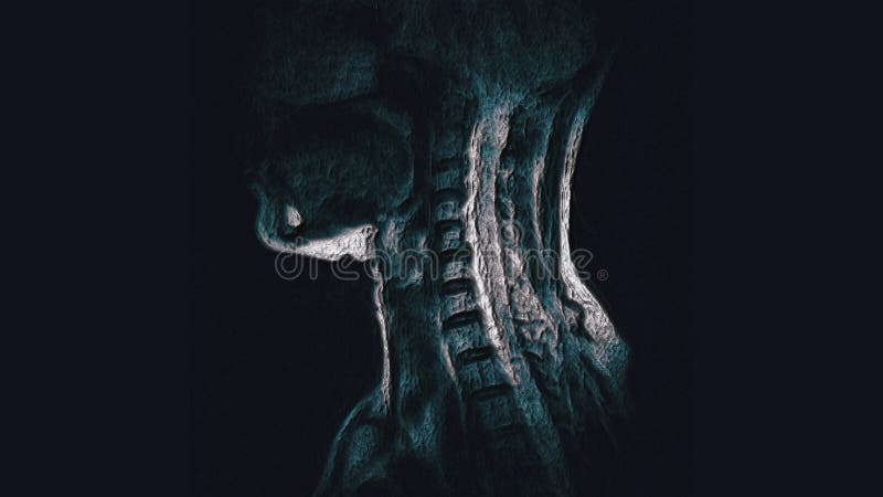 Voluminous Color MRI of the Cervical Spine, Detection of Protrusions ...