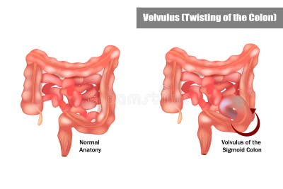 Volvulus of the Sigmoid Colon Stock Illustration - Illustration of ...
