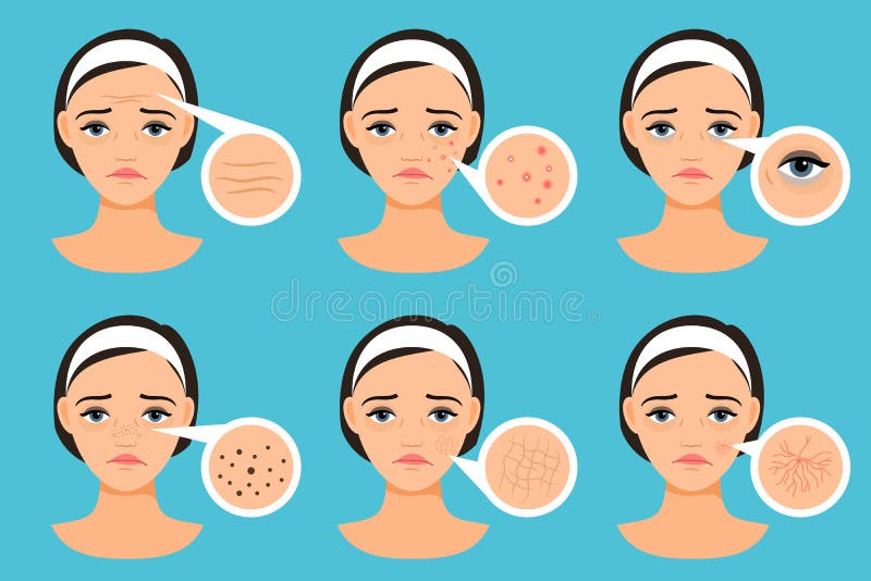 De Huidprobleem Begraven Haarvaten Van Het Mensengezicht Vector ...