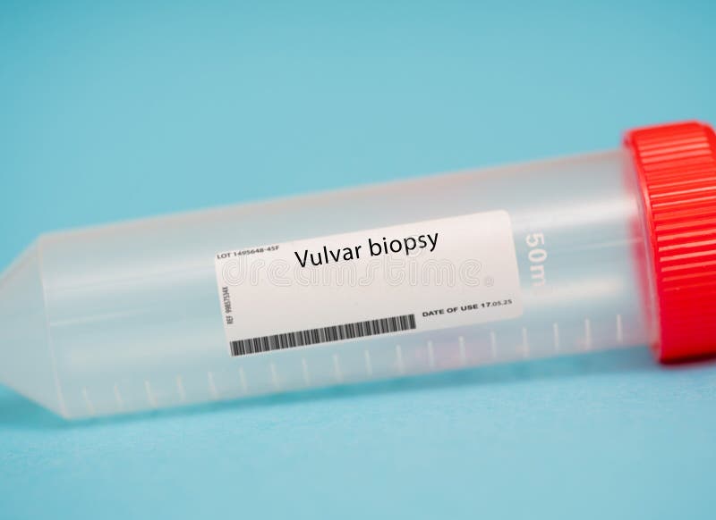 Vulvar biopsy stock image. Image of checkup, vaginalis - 275972457