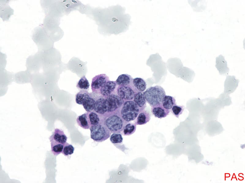 Periodic Acid–Schiff Stain (PAS). Bone Marrow. Stock Photo - Image of ...