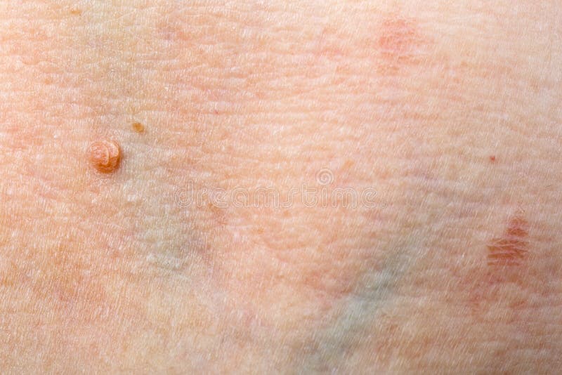 Wart on human skin stock image. Image of dermatological - 94578219