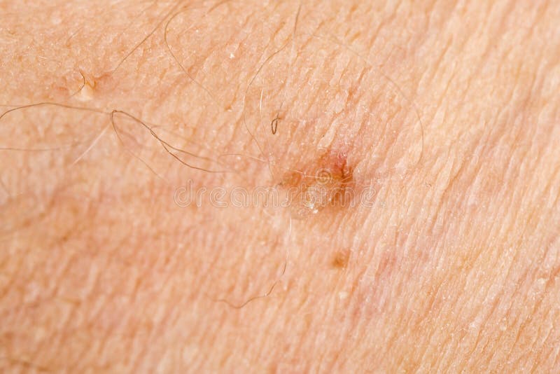 Wart on human skin stock image. Image of malignant, hairy - 94578595