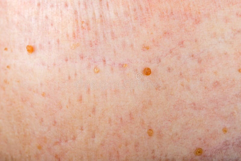 Warts on human skin stock photo. Image of keratosis, contagious - 94578624