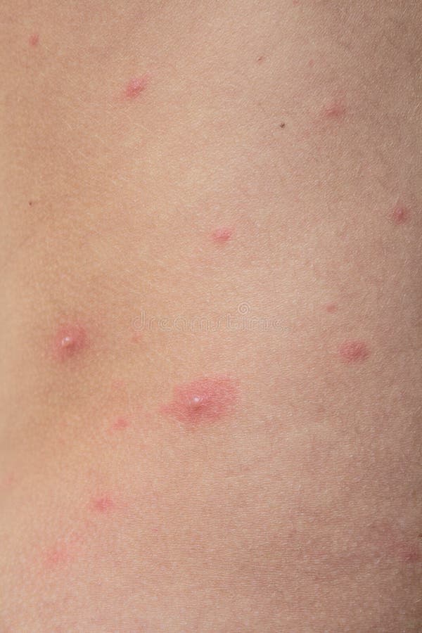 Waterpokken stock afbeelding. Afbeelding bestaande uit immuniteit ...
