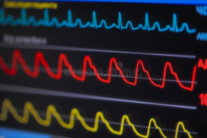 Waves ECG on Monitor in Perspective Stock Photo - Image of heart ...
