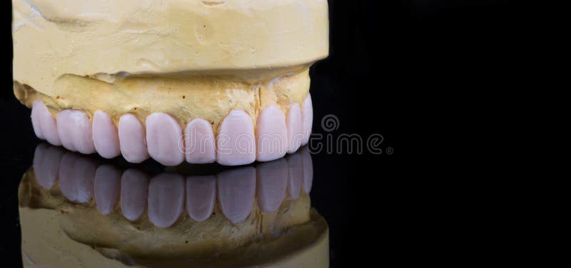 Wax Pattern Teeth Dental Crowns on Model, Metal Free - Front View ...