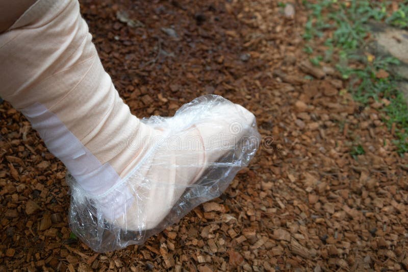 Wearing a Plastic Bag Over the Cast while Walking Stock Image - Image ...