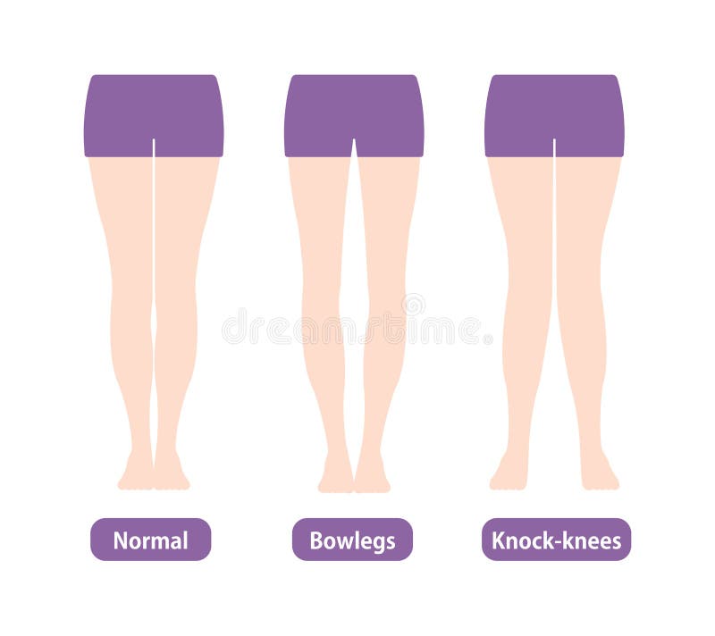 Difference Types of Legs Angles and Knees Vector Illustration . Normal ...