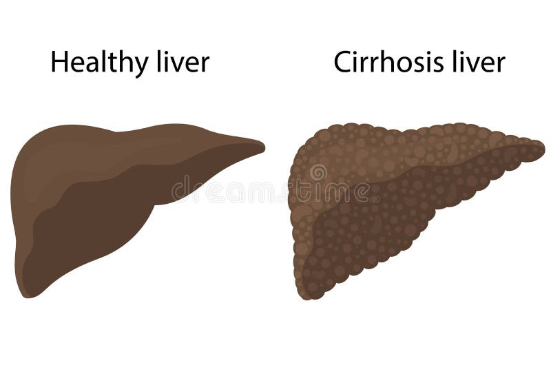 Cirrhosis of the liver stock vector. Illustration of body - 191362390