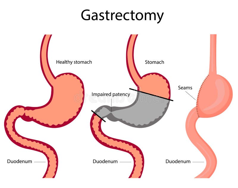 Vector Illustration of Gastrectomy. Stock Vector - Illustration of ...