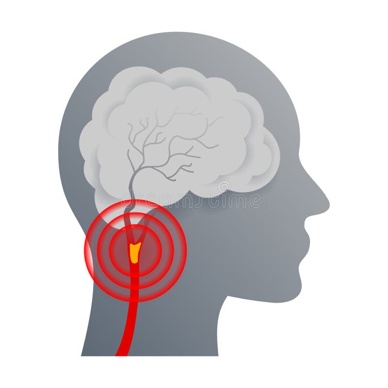 Cerebrovascular Disease Ischemic Icon Stock Vector - Illustration of ...