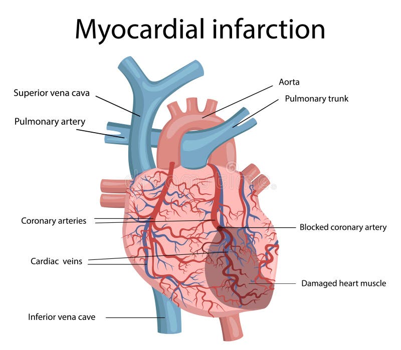 Human heart disease stock vector. Illustration of artery - 192880033
