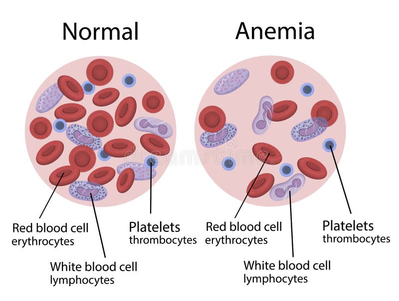 Vector Illustration of Anemia Stock Vector - Illustration of biology ...