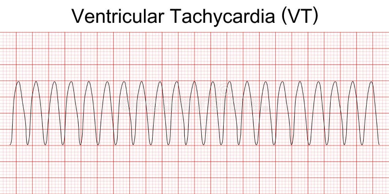 Ventricular Tachycardia Stock Illustrations – 222 Ventricular ...