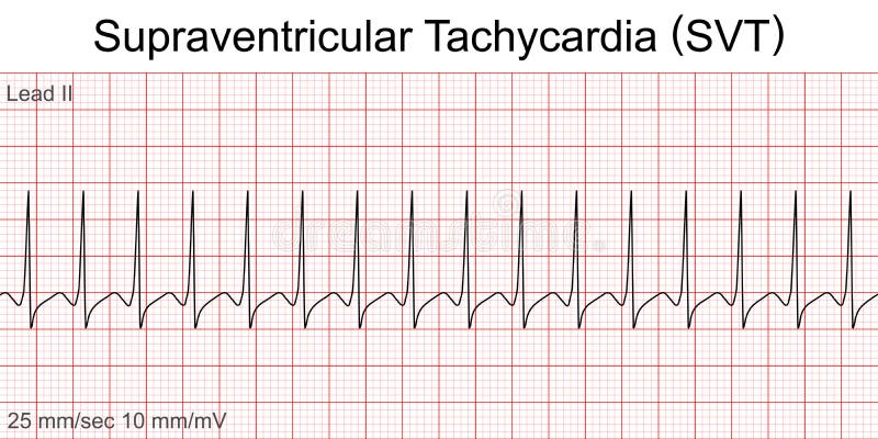 Electrocardiogram Show Supraventricular Tachycardia SVT Pattern. Stock ...