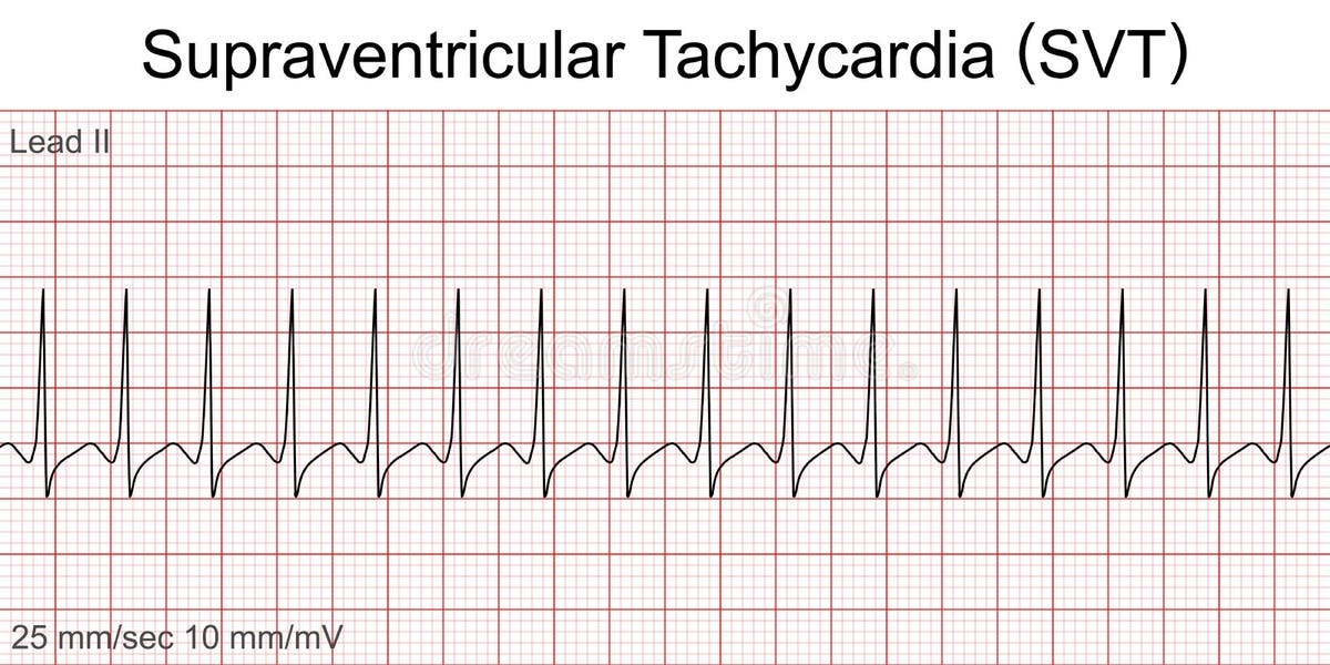 Sinus Tachycardia Stock Illustrations – 39 Sinus Tachycardia Stock ...