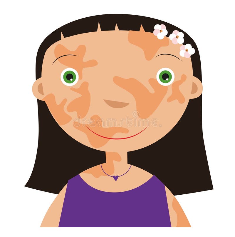 Vitiligo Clipart Stock Illustrations – 50 Vitiligo Clipart Stock ...