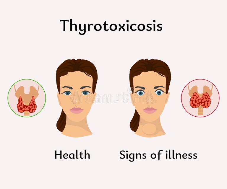 Thyrotoxicosis Thyroid Gland Medical Poster Stock Vector - Illustration ...