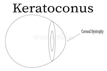 Corneal Abrasion Stock Illustrations – 8 Corneal Abrasion Stock ...