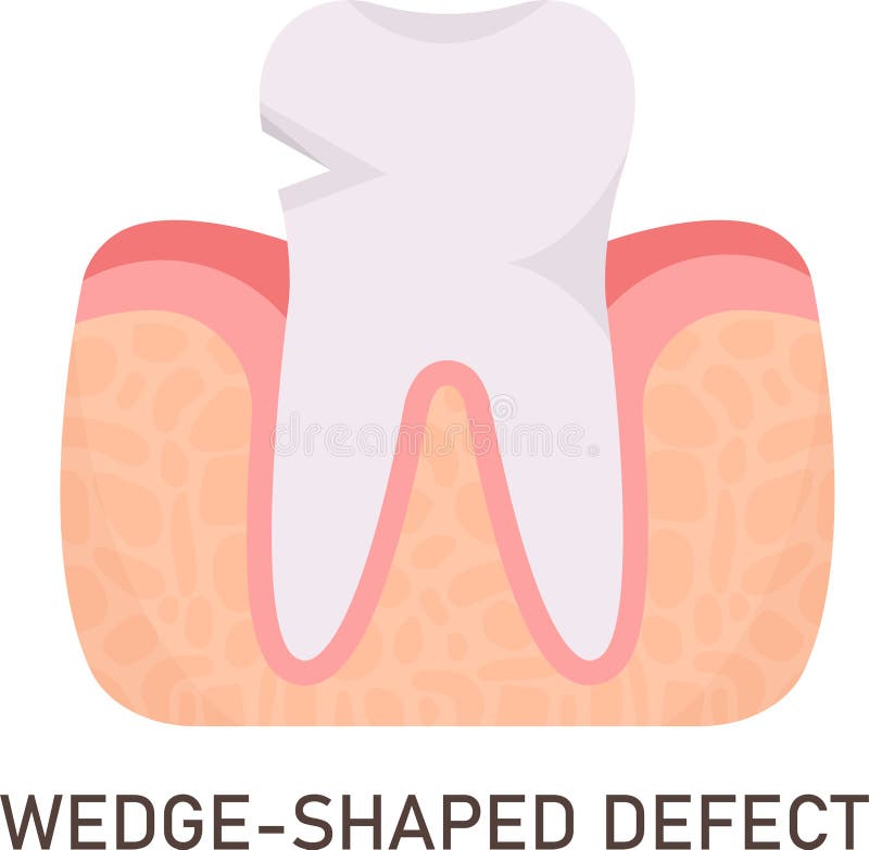 Wedge-Shaped Defect Tooth Problem Stock Vector - Illustration of ...