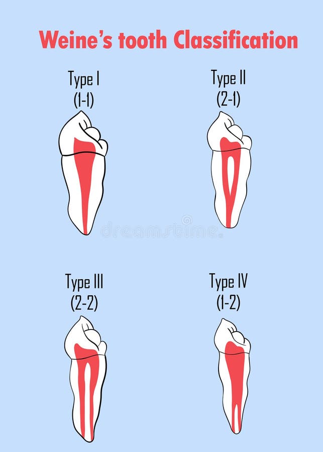 Weine S Classification of Root Canal Morphology from Type I To Type IV ...