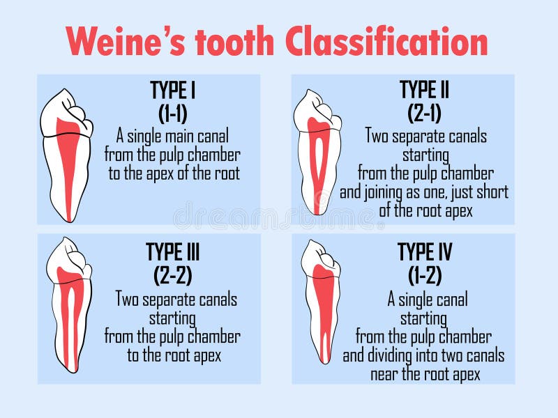 Weine S Classification of Root Canal Morphology from Type I To Type IV ...