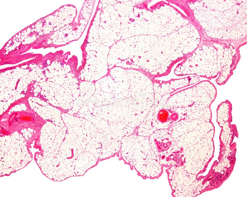 Human Appendix. Eosinophils Stock Photo - Image of appendicitis ...