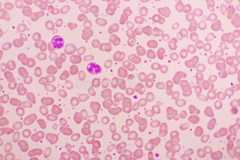 White Blood Cell in Blood Smear Stock Image - Image of thalassemia ...
