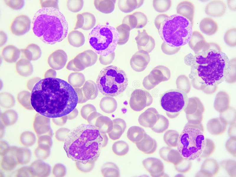 Lymphocyte Cells in Blood Smear Stock Image - Image of care ...
