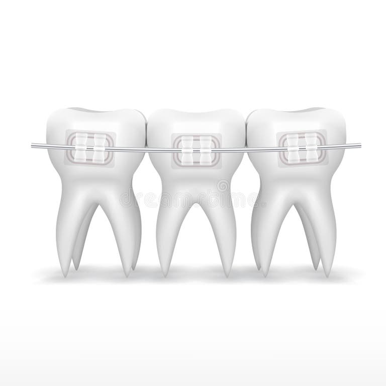 White Ceramic Braces Stock Illustrations – 284 White Ceramic Braces ...