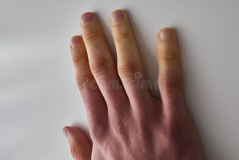 White Fingers from the Cold, Poor Blood Circulation,close Up Stock ...