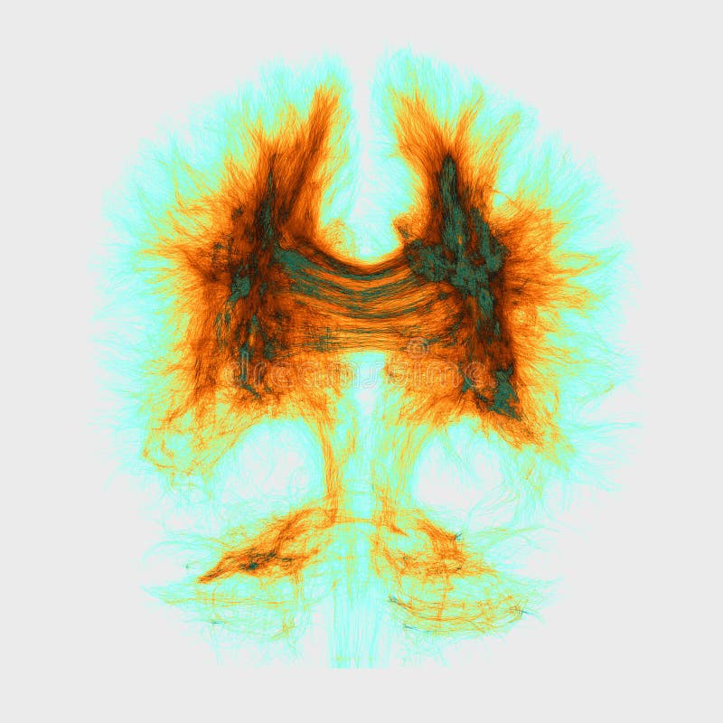 White Matter Tractography of the Human Brain Stock Illustration ...