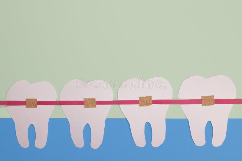 White Paper Teeth in Dental Braces Stock Photo - Image of medicine ...