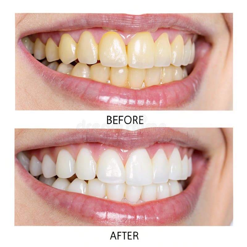 Before and after White Teeth Isolated on Transparent Background Stock ...